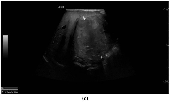 Review on Pediatric Malignant Focal Liver Lesions with Imaging ...