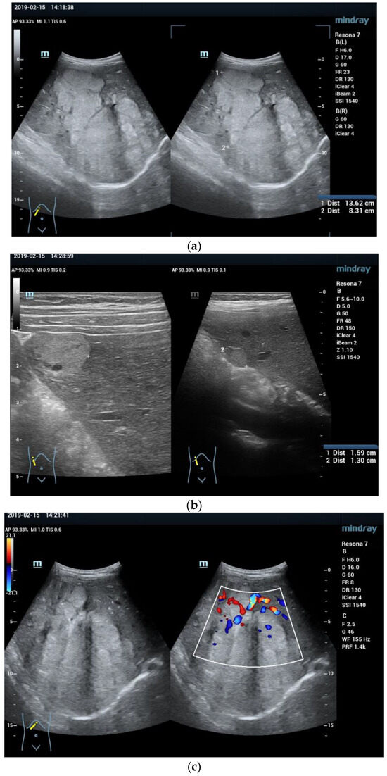 Review on Pediatric Malignant Focal Liver Lesions with Imaging ...