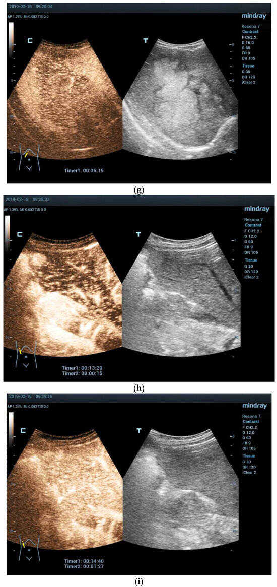 Review on Pediatric Malignant Focal Liver Lesions with Imaging ...