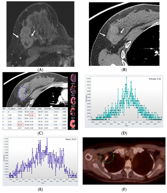 Tumor Heterogeneity of Breast Cancer Assessed with Computed Tomography ...