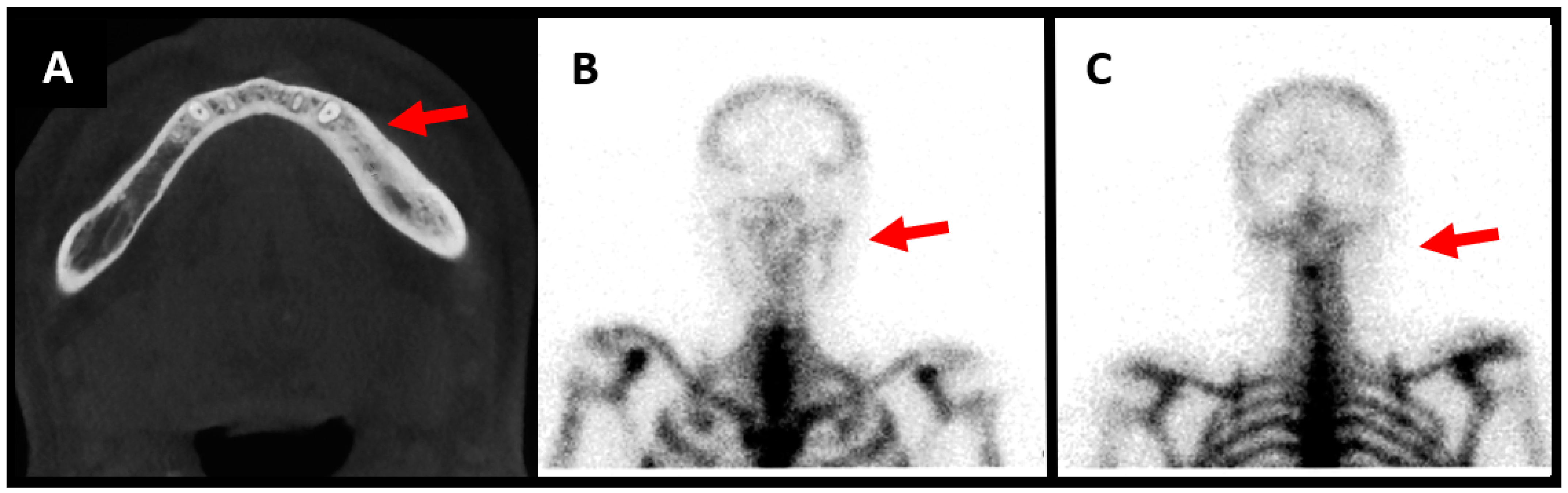 Primary Chronic Sclerosing Osteomyelitis: A New Diagnostic Tool