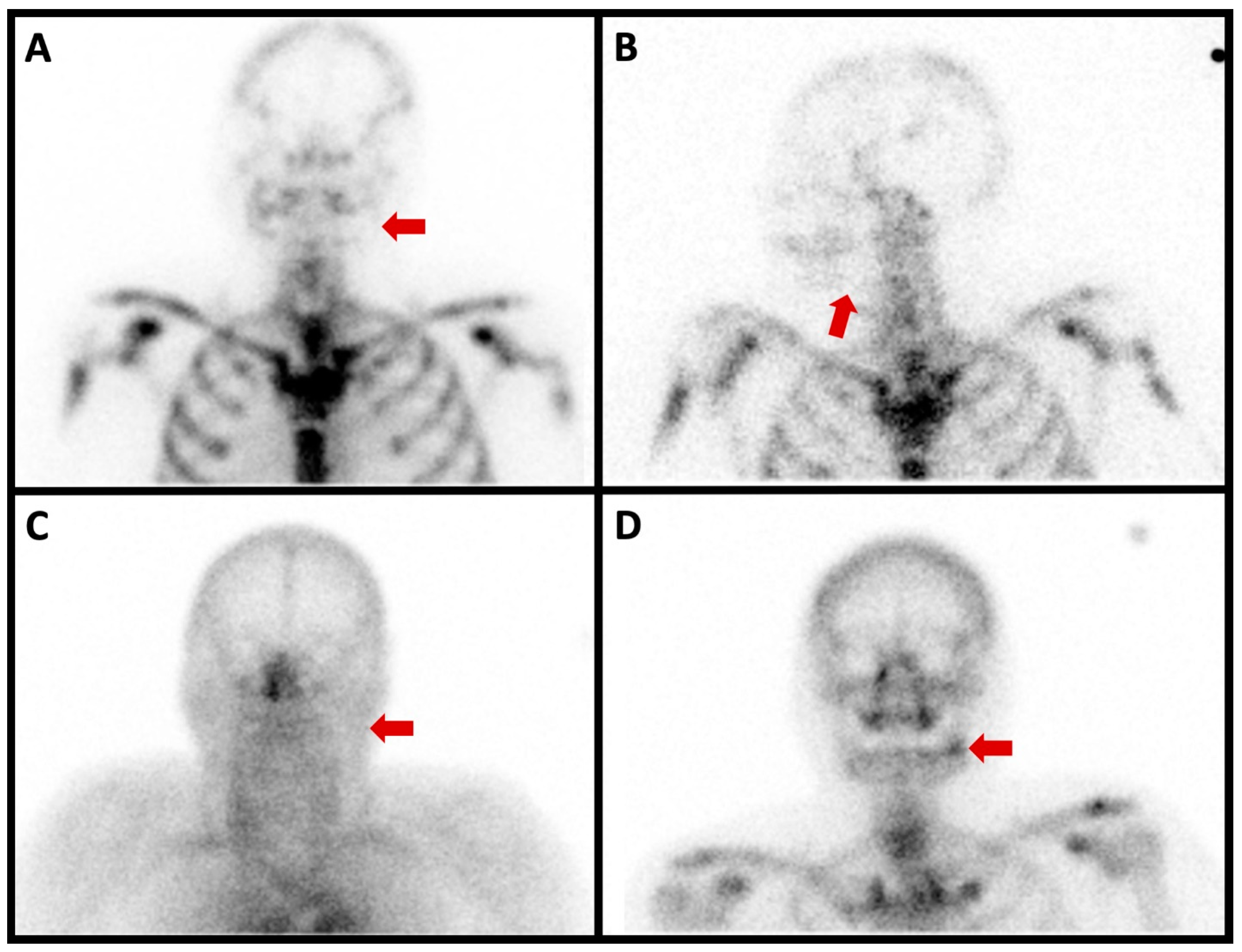 Primary Chronic Sclerosing Osteomyelitis: A New Diagnostic Tool