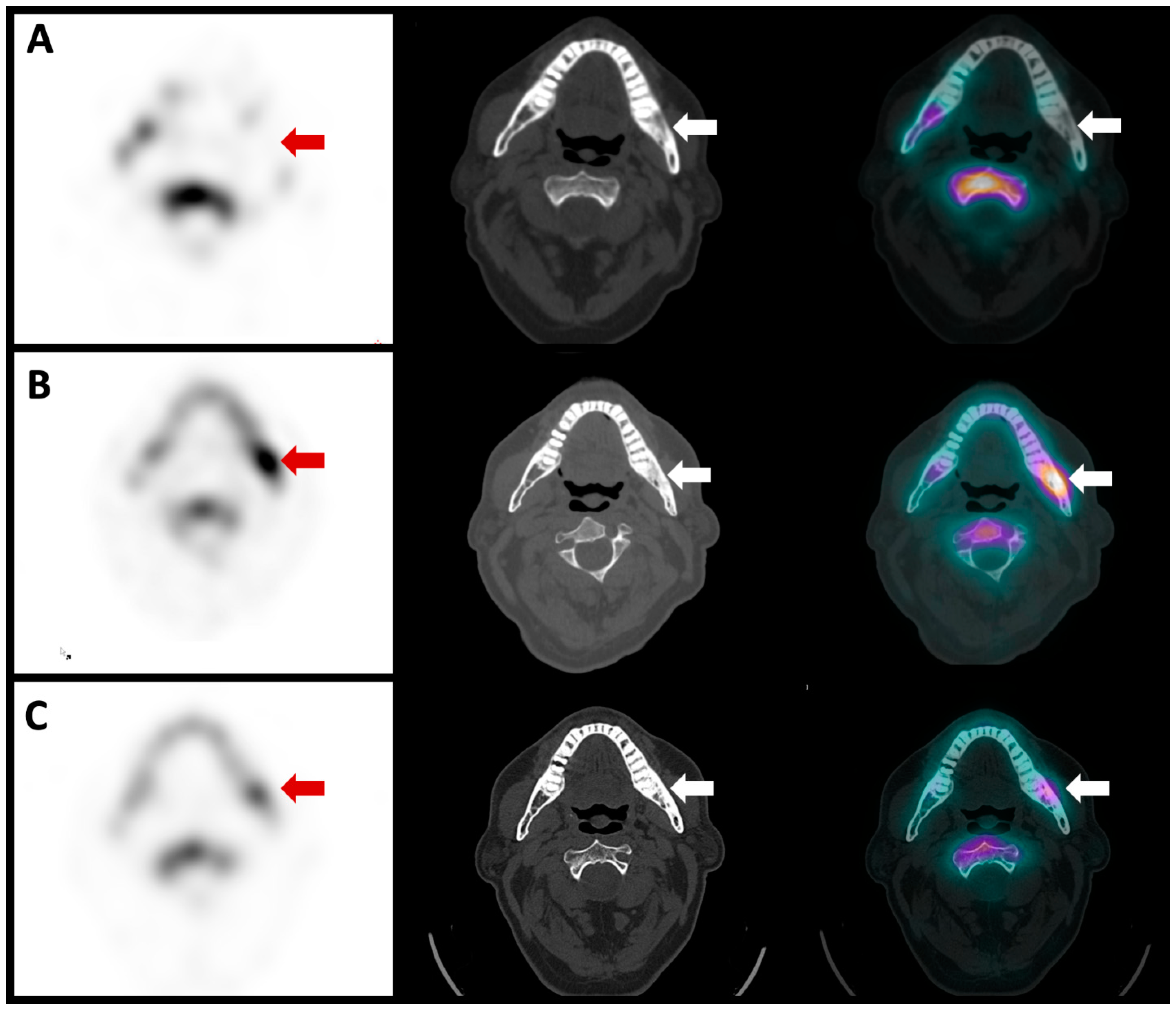 Primary Chronic Sclerosing Osteomyelitis: A New Diagnostic Tool