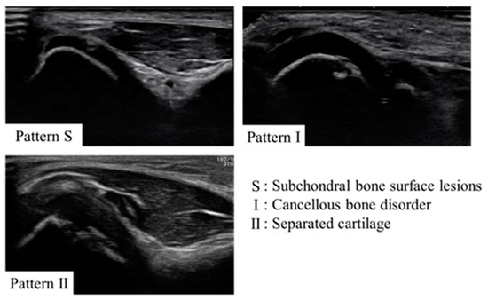 Detection of Factors Related to the Development of Osteochondritis ...