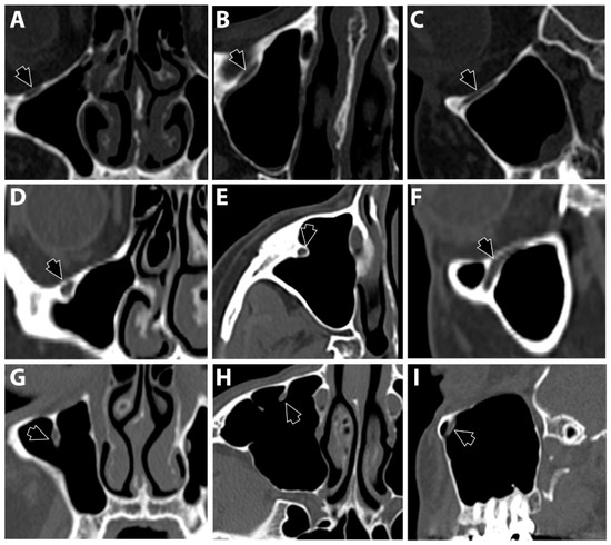 The Associations between the Maxillary Sinus Volume, Infraorbital ...