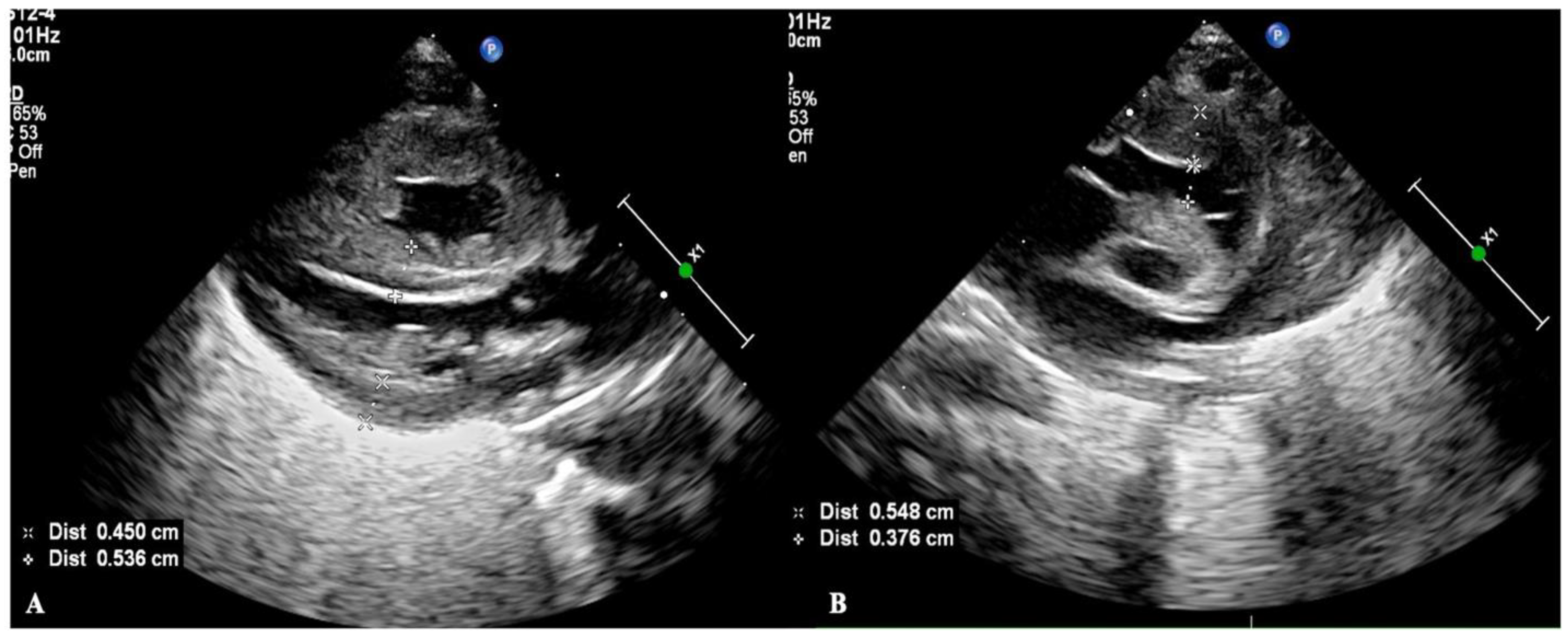 Myocardial Edema: A Rare but Specific Manifestation of Neonatal ...