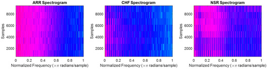 Deep-Learning-Based Arrhythmia Detection Using ECG Signals: A ...