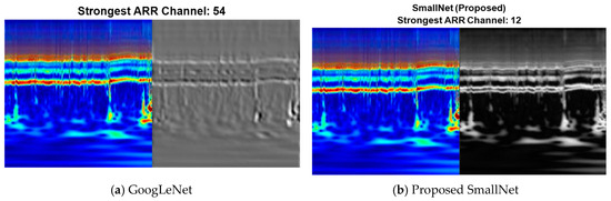 Deep-Learning-Based Arrhythmia Detection Using ECG Signals: A ...