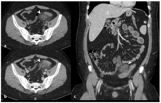 Acute Colonic Diverticulitis: CT Findings, Classifications, and a ...