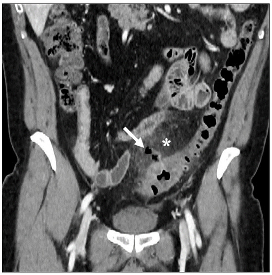 Acute Colonic Diverticulitis: CT Findings, Classifications, and a ...