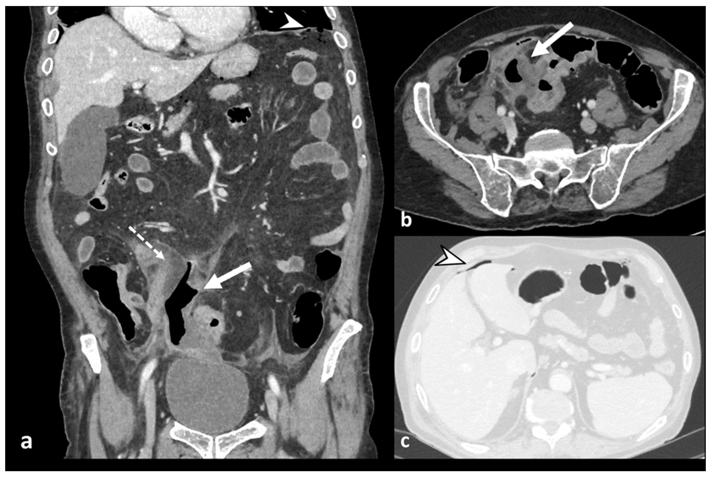 Acute Colonic Diverticulitis: CT Findings, Classifications, and a ...