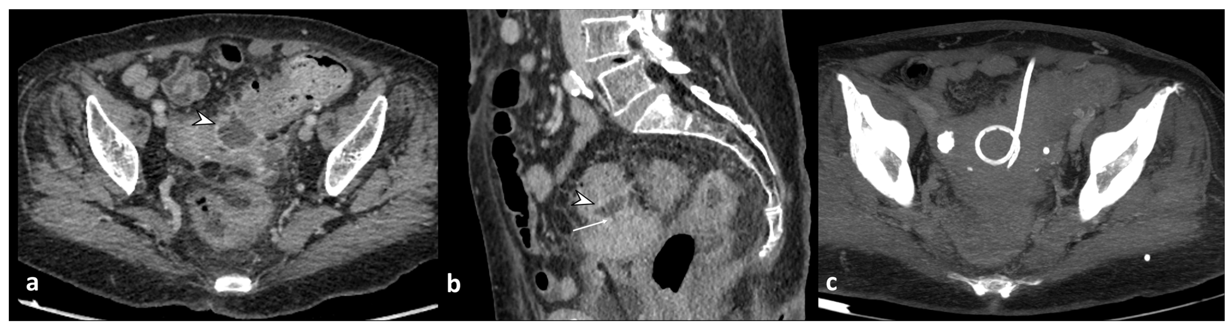 Acute Colonic Diverticulitis: CT Findings, Classifications, and a ...