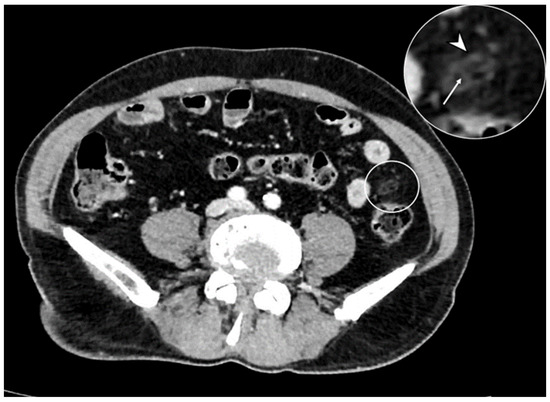 Acute Colonic Diverticulitis: CT Findings, Classifications, and a ...
