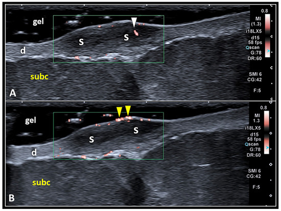 From Histopathology to High-Resolution Ultrasound Imaging of Skin Scars