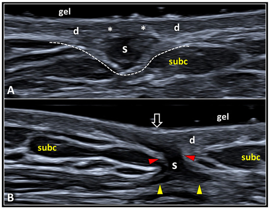 From Histopathology to High-Resolution Ultrasound Imaging of Skin Scars