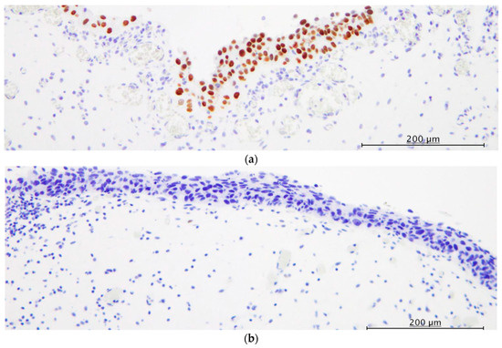 Expression of Preferentially Expressed Antigen in Melanoma, a Cancer ...