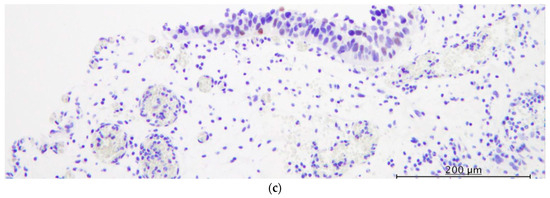 Expression of Preferentially Expressed Antigen in Melanoma, a Cancer ...