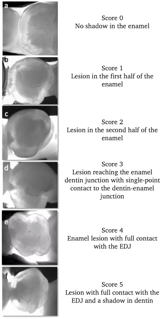 Detection, Diagnosis, and Monitoring of Early Caries: The Future of ...