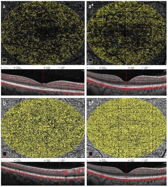 Evaluation of Macular and Optic Disc Radial Peripapillary Vessel ...