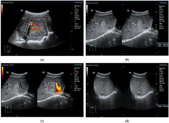 Diagnostics | Free Full-Text | Review on Pediatric Malignant Focal ...