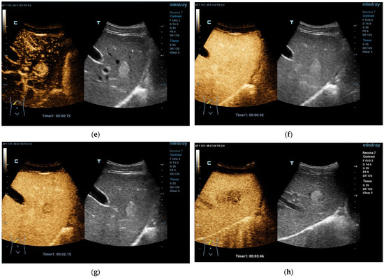 Review on Pediatric Malignant Focal Liver Lesions with Imaging ...