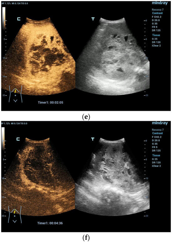 Review on Pediatric Malignant Focal Liver Lesions with Imaging ...