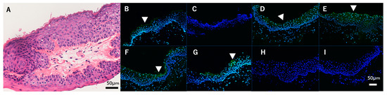 Immunohistochemistry in an Adult Case of Bitot’s Spots Caused by ...