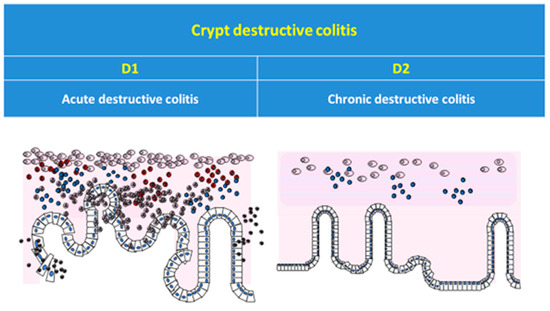 The Histology-Driven Differential Diagnosis in Bowel Inflammatory ...