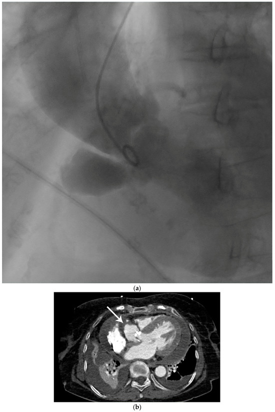 Incidental Finding of Subannular Perfused Aortic Root Abscess