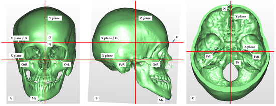 Three-Dimensional Analysis of the Cranial Base Structure in Patients ...