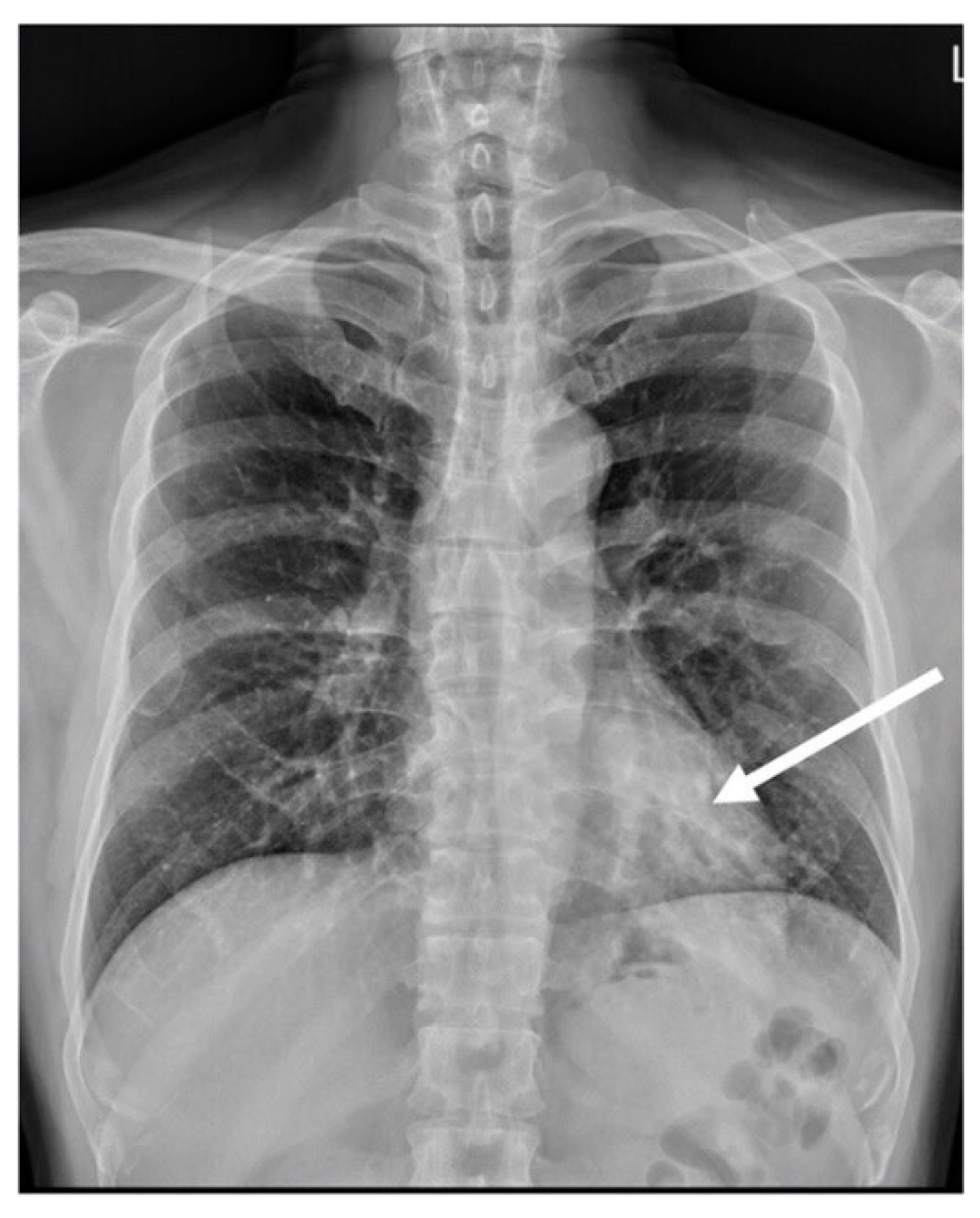 Rare Condition of Aberrant Arterial Supply to a Normal Lung: A Cases ...