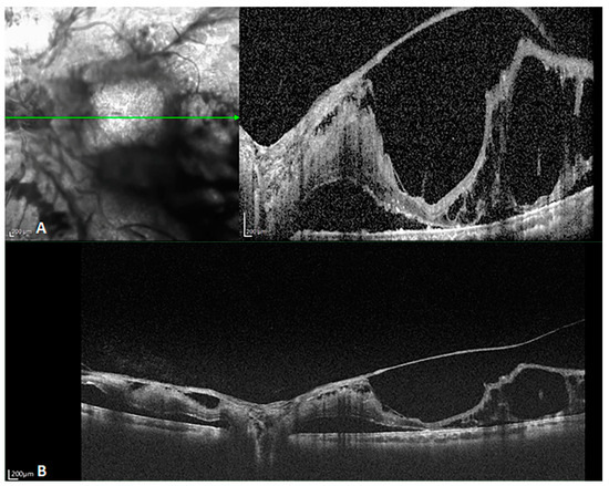 The Latest Updates in Swept-Source Optical Coherence Tomography Angiography