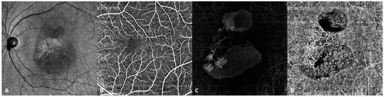 The Latest Updates in Swept-Source Optical Coherence Tomography Angiography