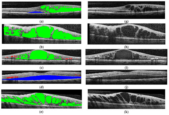 Diabetic Macular Edema Optical Coherence Tomography Biomarkers Detected ...