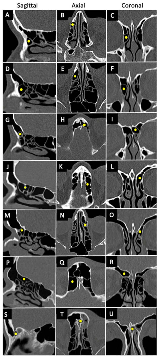 Does Frontal Recess Cell Variation Associate with the Development of ...