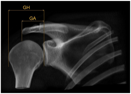 Establishing Normative Values for Acromion Anatomy: A Comprehensive MRI ...