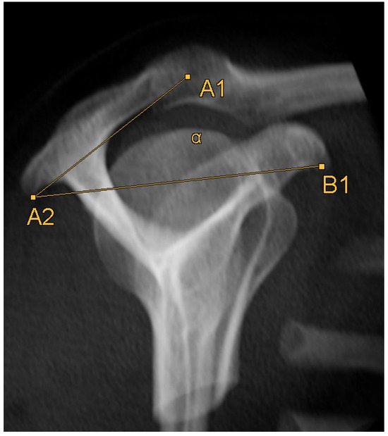 Acromion Types Mri