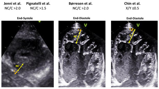 RETRACTED: Left Ventricular Non-Compaction in Children: Aetiology and ...