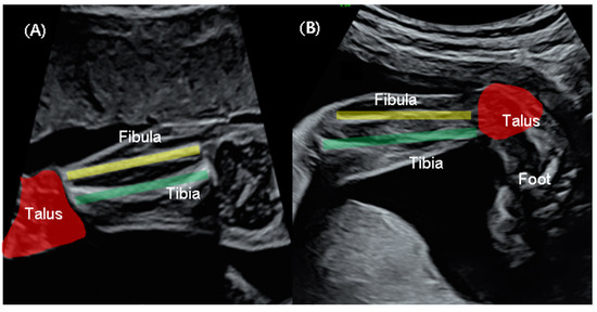 Improving Prenatal Diagnosis Precision for Congenital Clubfoot by Using ...