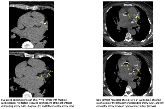 Artificial Intelligence in Coronary Artery Calcium Scoring Detection and Quantification