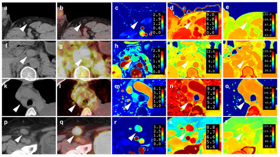 Diagnostics | Free Full-Text | Dual-Layer Spectral Detector Computed Tomography Quantitative ...