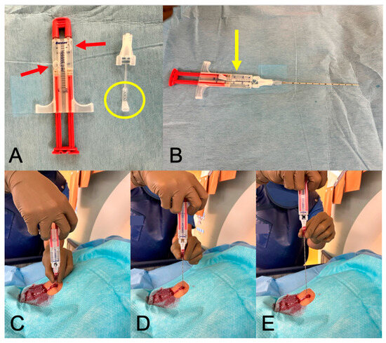 Percutaneous Computed Tomography (CT) Fluoroscopy-Guided Biopsy of the ...
