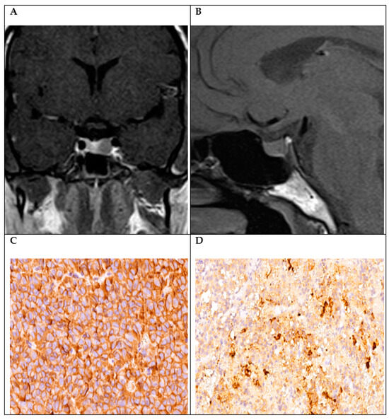 Plurihormonal Pituitary Neuroendocrine Tumors: Clinical Relevance of ...