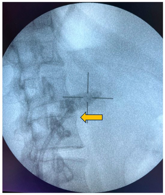 Predictive Factors Correlated with Successful Early Endoscopic Removal ...