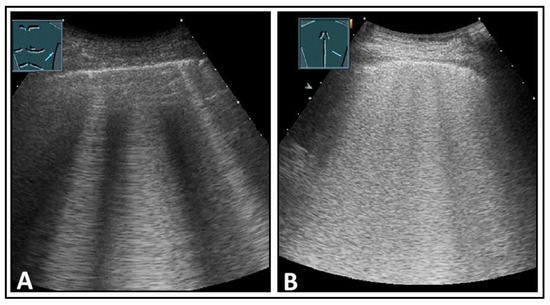 Lung Ultrasound and Pleural Artifacts: A Pictorial Review