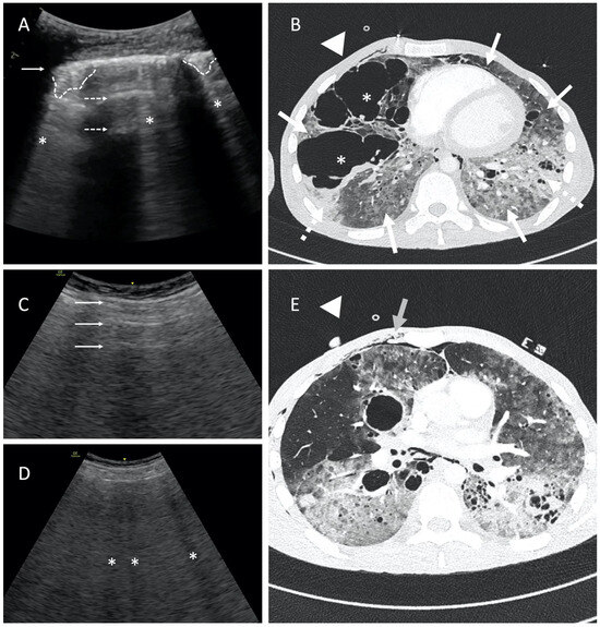 Detection of Pneumothorax in Severe Acute Respiratory Distress Syndrome ...