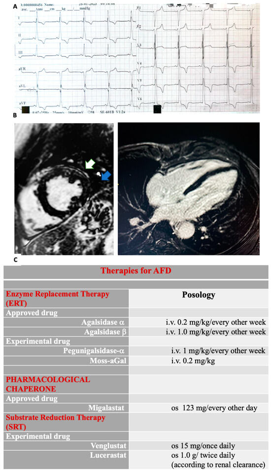 Anderson–Fabry Disease: Red Flags for Early Diagnosis of Cardiac ...