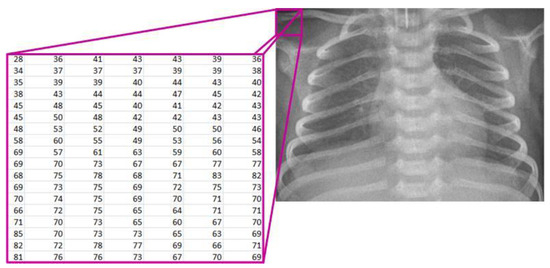 Advanced Diagnostics of Respiratory Distress Syndrome in Premature ...