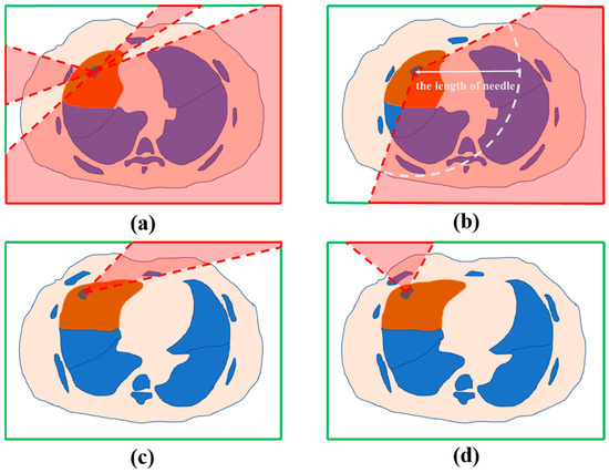 An Automatic Needle Puncture Path-Planning Method for Thermal Ablation ...