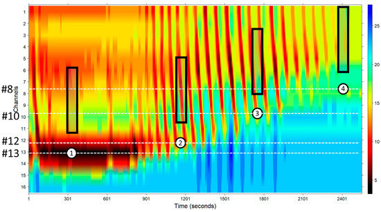 A New Method to Evaluate Lower Esophageal Distension Capacity in ...